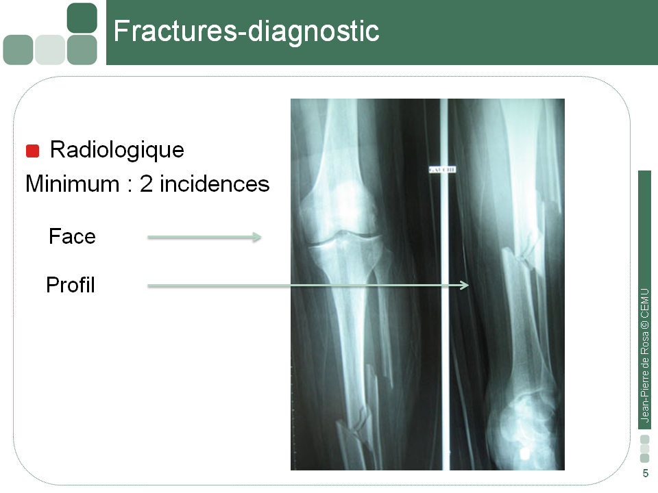 IFSI 2013 - Les processus traumatiques : 02 - Le diagnostic des ...