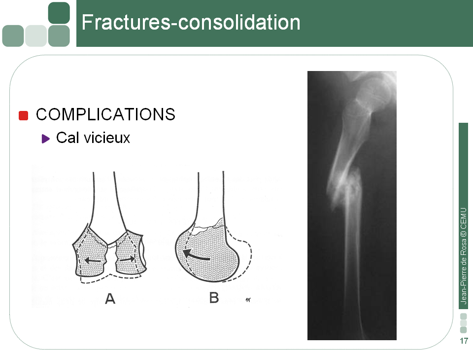 IFSI 2013 - Les processus traumatiques : 02 - Le diagnostic des ...